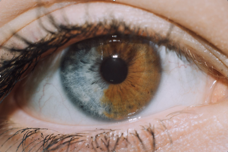 People With Rare Genetic Traits You Don’t See Every Day - Kate Knows