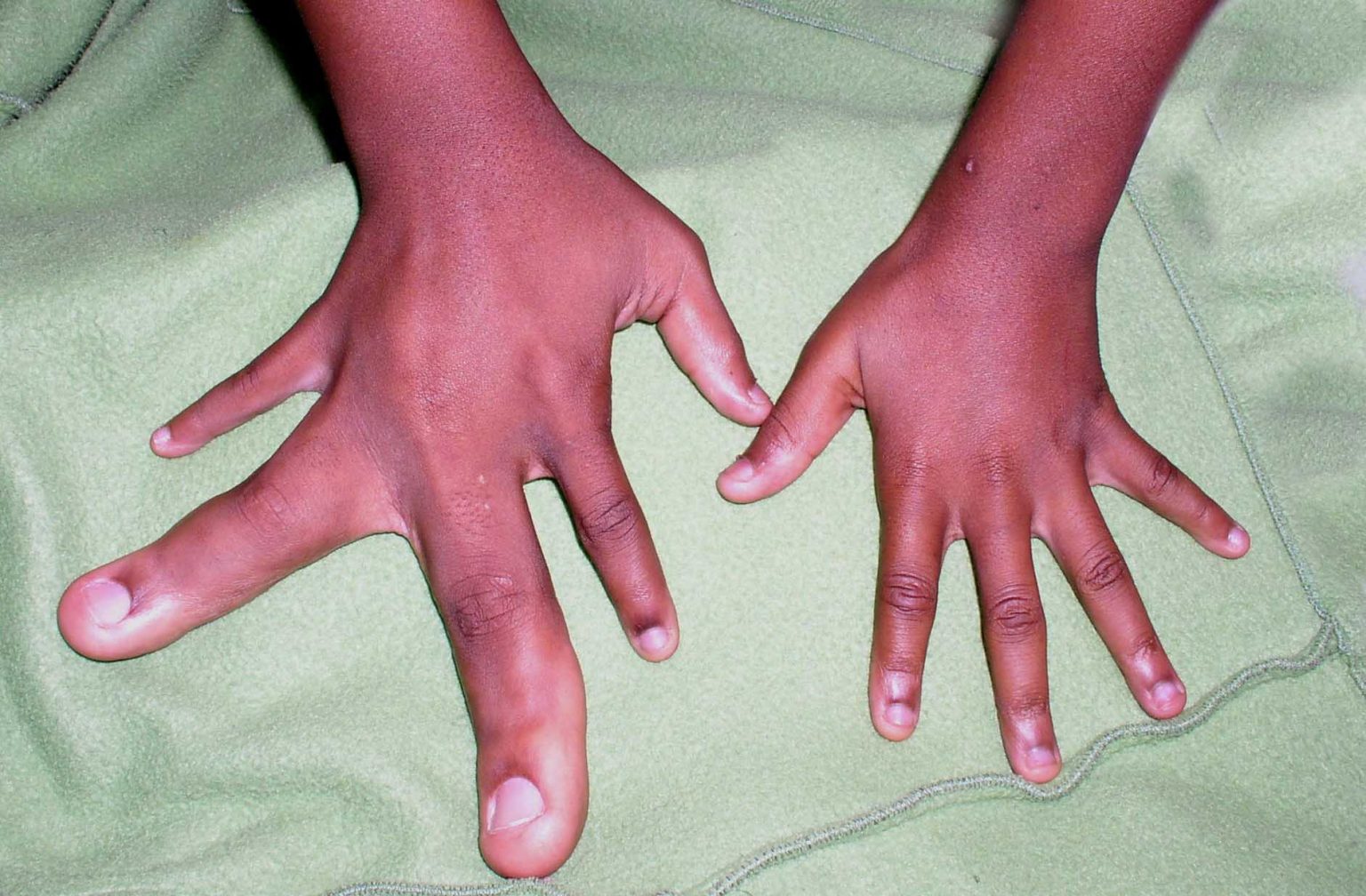 People With Rare Genetic Traits You Don’t See Every Day - Kate Knows