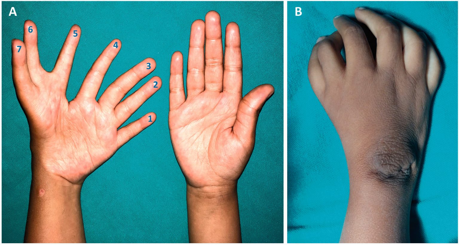 People With Rare Genetic Traits You Don’t See Every Day - Kate Knows