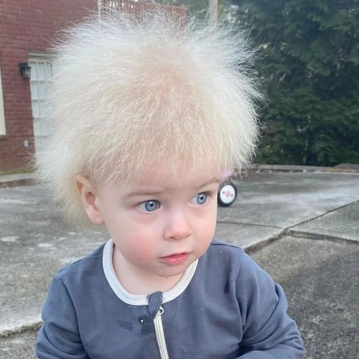 People With Rare Genetic Traits You Don’t See Every Day - Kate Knows
